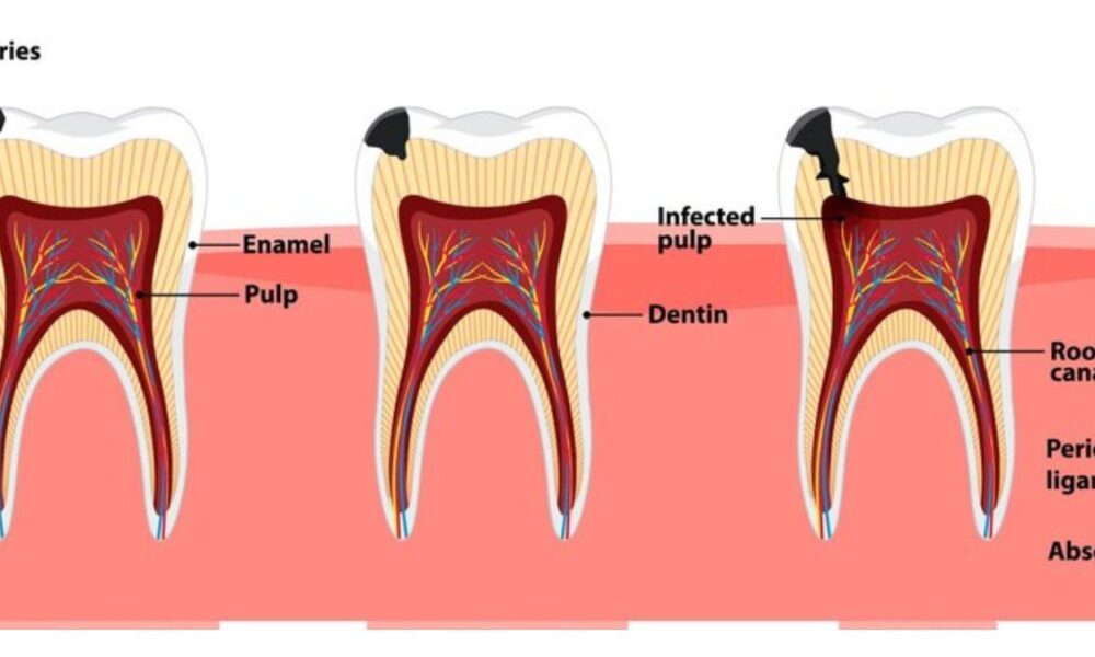 What Happens During a Root Canal: A Step-by-Step Guide