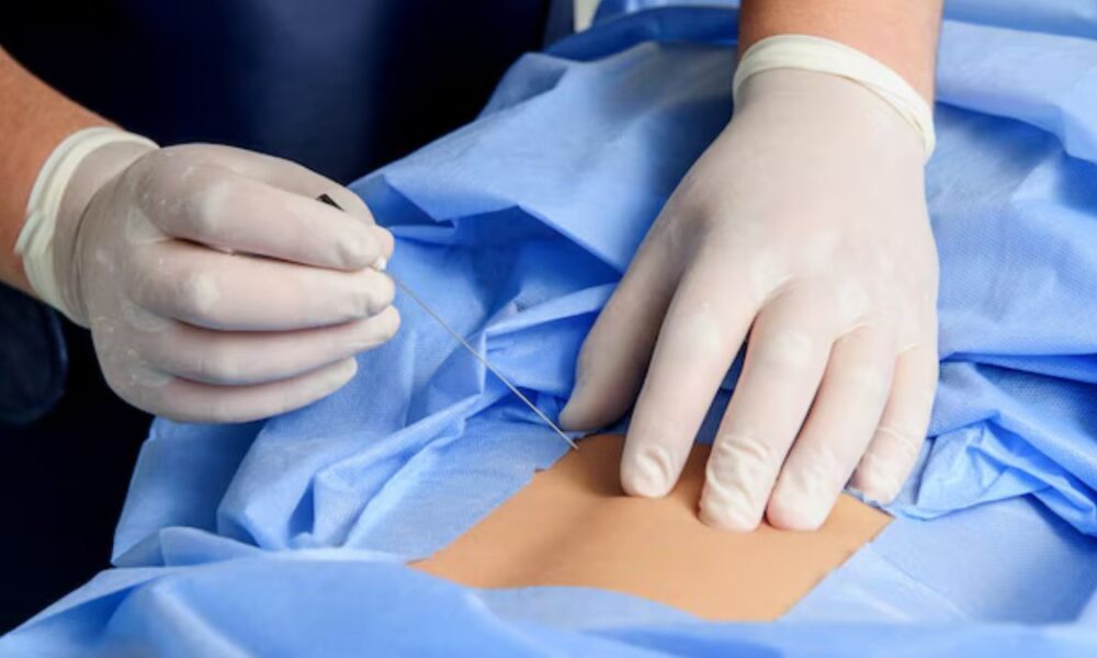 Pilonidal Surgery: Things To Know