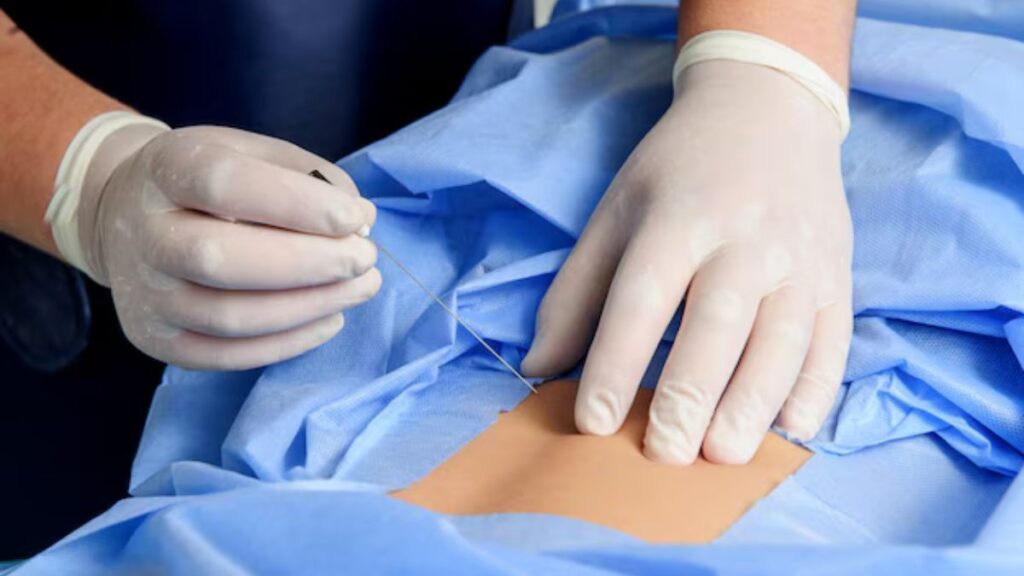 Pilonidal Surgery: Things To Know