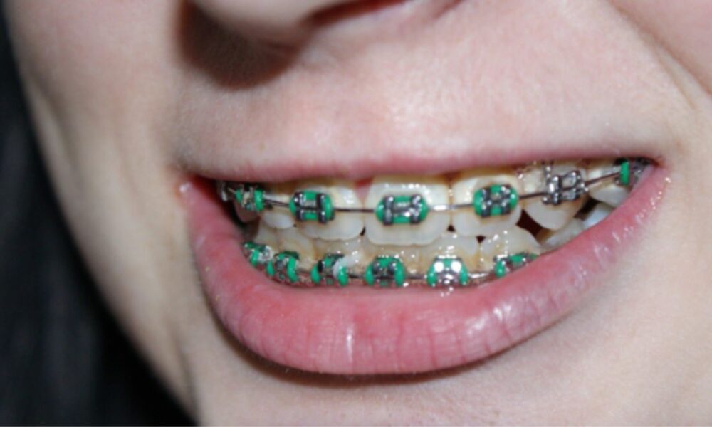A Guide to Types of Dental Braces: Traditional, Clear, and Beyond